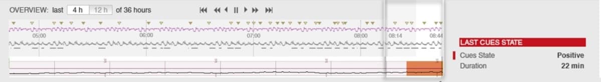 Early warning systems in obstetrics - PeriWatch Vigilance
